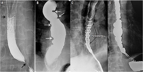 Esofagograma: imágenes que valen más que mil palabras