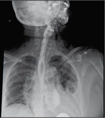 Síndrome de Boerhaave