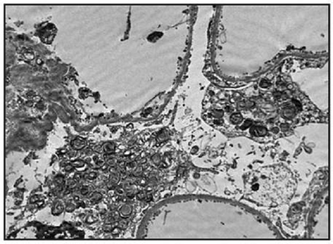 Chloroquine-induced renal phospholipidosis