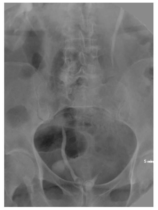 Ureterocele bilateral con litiasis