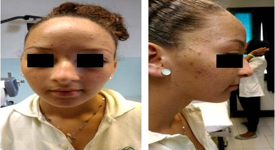 Síndrome de Axenfeld-Rieger. Presentación de un caso