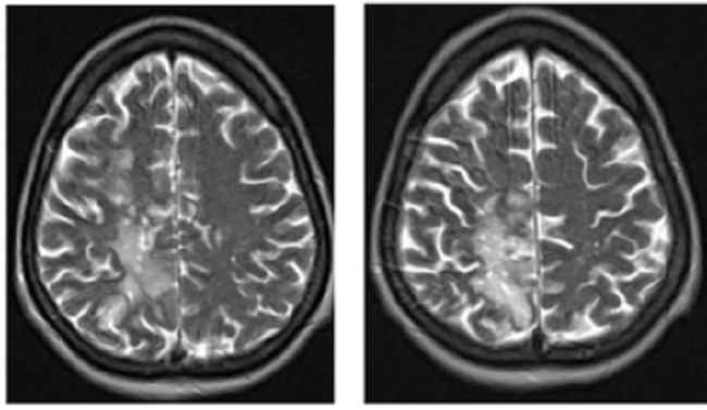 Brain nocardiosis: presentation of a case