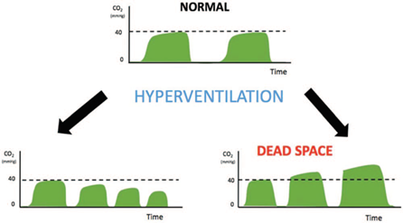 How to ventilate the anesthetized child with the modern anesthesia ...