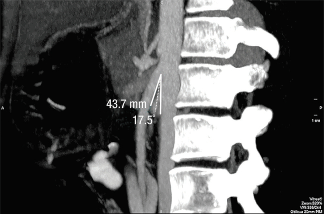 Heterozygote Triplets. A Rare Case of Wilkie’s Syndrome