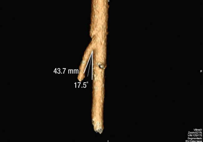 Heterozygote Triplets. A Rare Case of Wilkie’s Syndrome