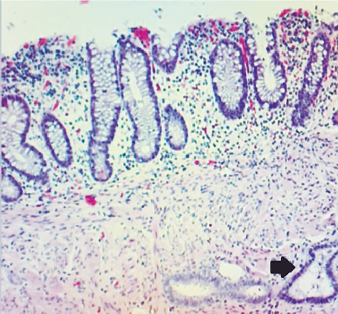 Endometriosis intestinal, una causa de suboclusión intestinal poco ...
