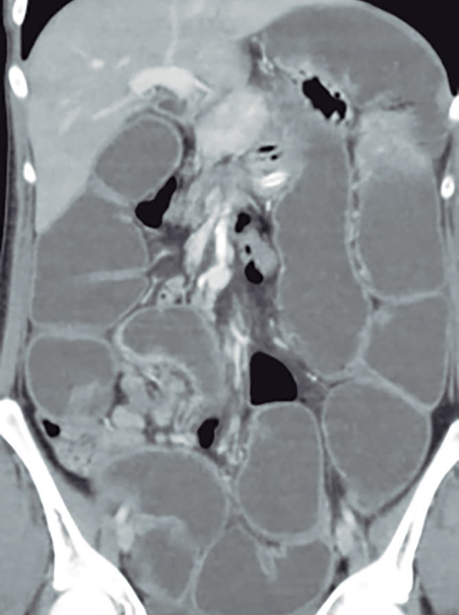 Endometriosis intestinal, una causa de suboclusión intestinal poco ...