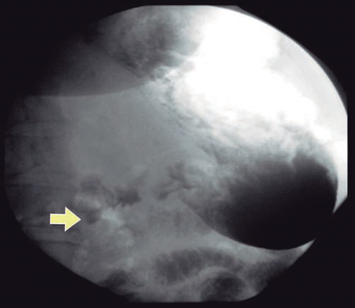 Solución del caso. Causa inusual de pancreatitis recurrente