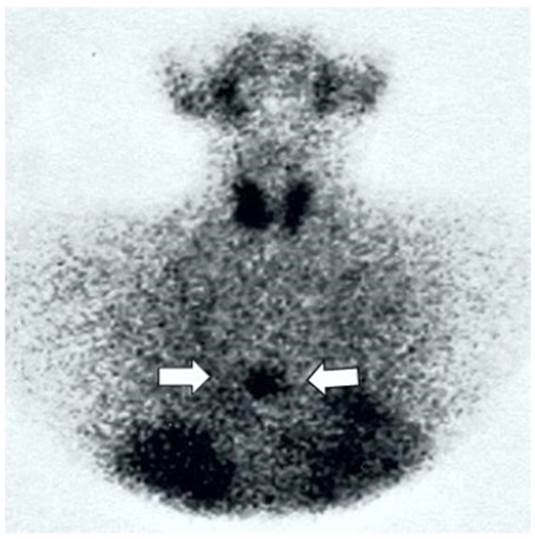 Adenoma paratiroideo mediastínico como causa de hiperparatiroidismo ...