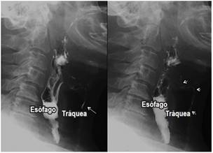 Esofagograma: imágenes que valen más que mil palabras