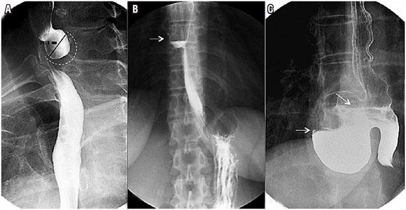 Esofagograma: imágenes que valen más que mil palabras