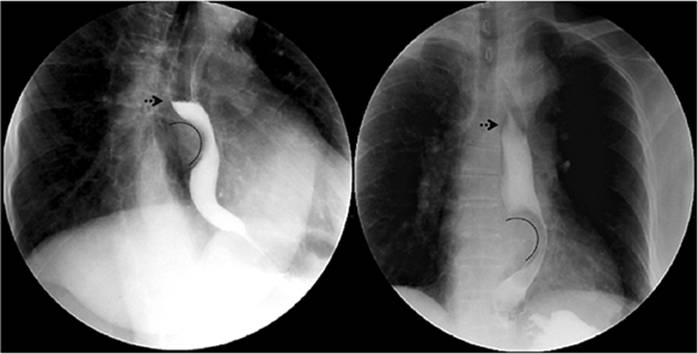 Esofagograma: imágenes que valen más que mil palabras