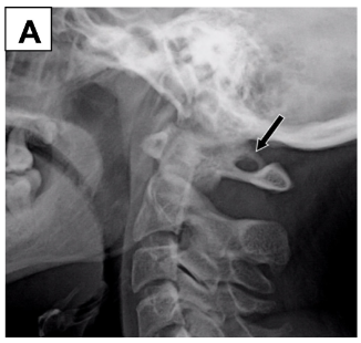 Ponticulus posticus. Lo que podría estar y no lo informamos