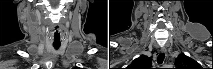 Manifestaciones tomográficas extrapulmonares de TBC y algunas de sus ...