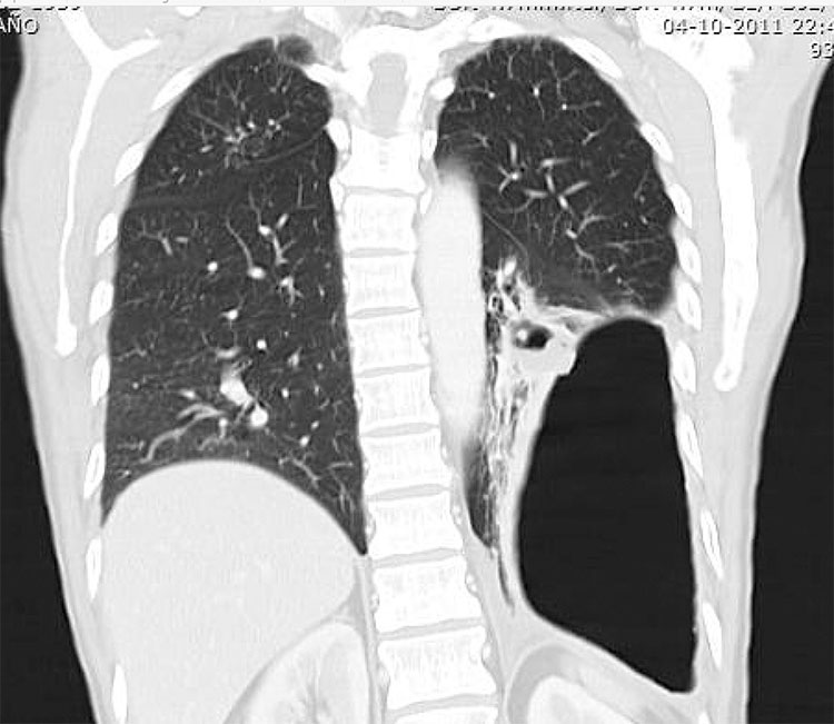 Manifestaciones tomográficas extrapulmonares de TBC y algunas de sus ...