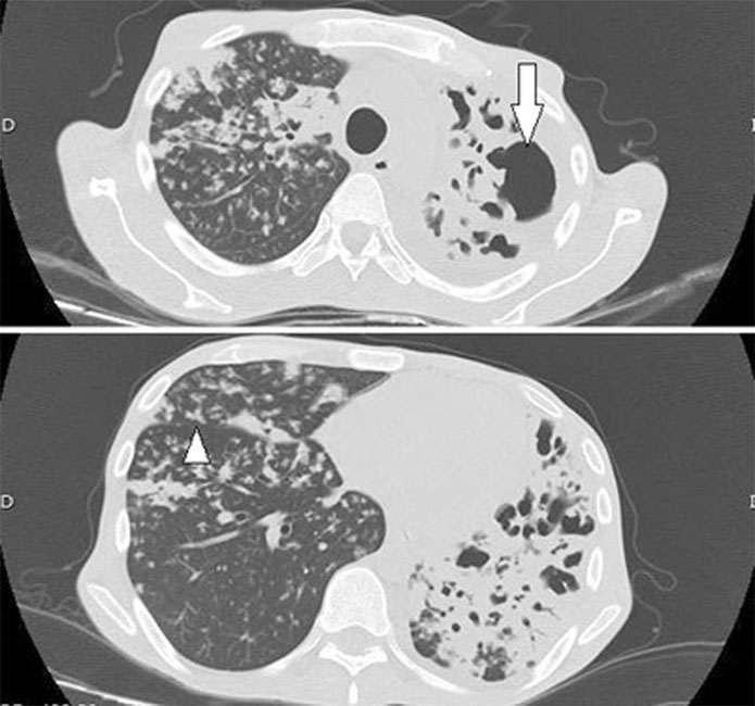 Manifestaciones tomográficas extrapulmonares de TBC y algunas de sus ...