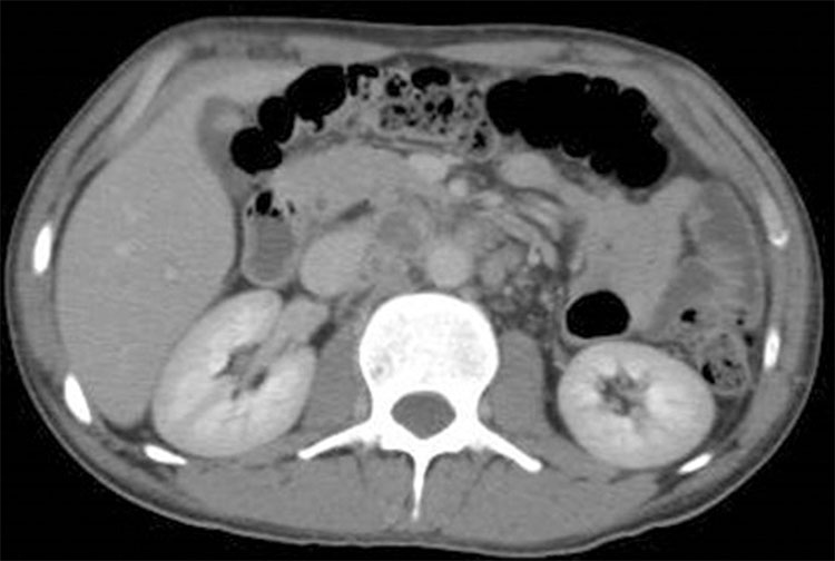 Manifestaciones tomográficas extrapulmonares de TBC y algunas de sus ...
