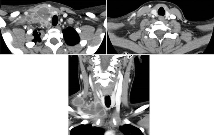 Manifestaciones tomográficas extrapulmonares de TBC y algunas de sus ...