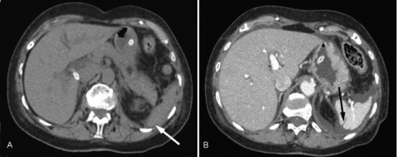 Espectro de hallazgos por TC multidetector en el trauma esplénico y ...