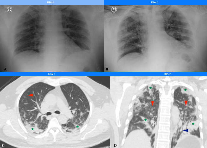 Coronavirus: experiencia en el departamento de imágenes de un hospital ...