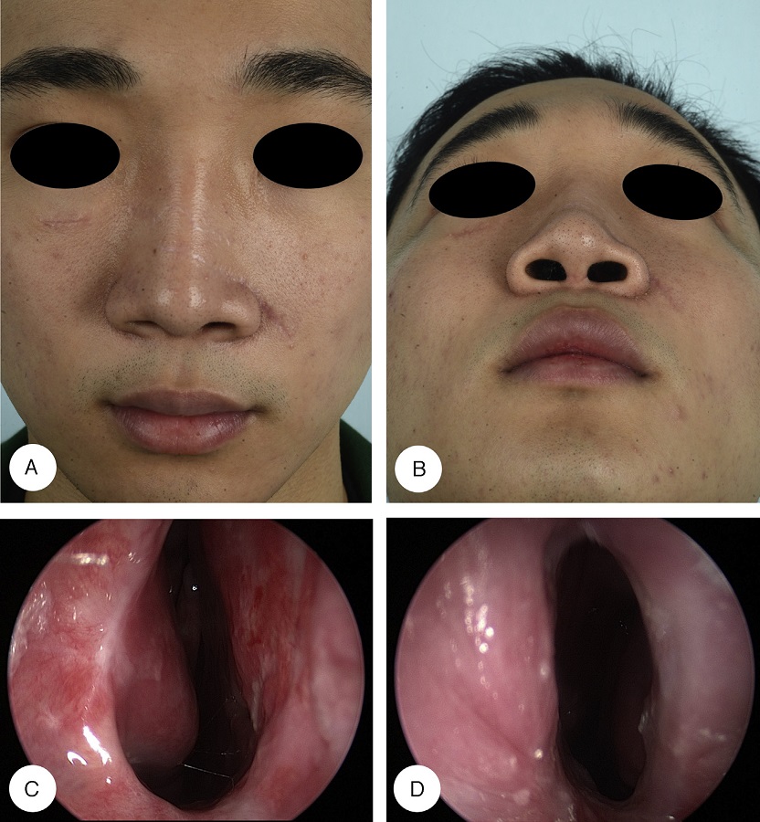 Iatrogenic nasal vestibular stenosis after maxillofacial reconstructive ...