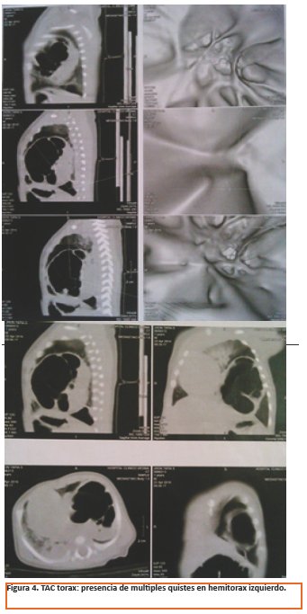 ENFISEMA LOBAR CONGÉNITO. PRESENTACIÓN DE CASO CLÍNICO