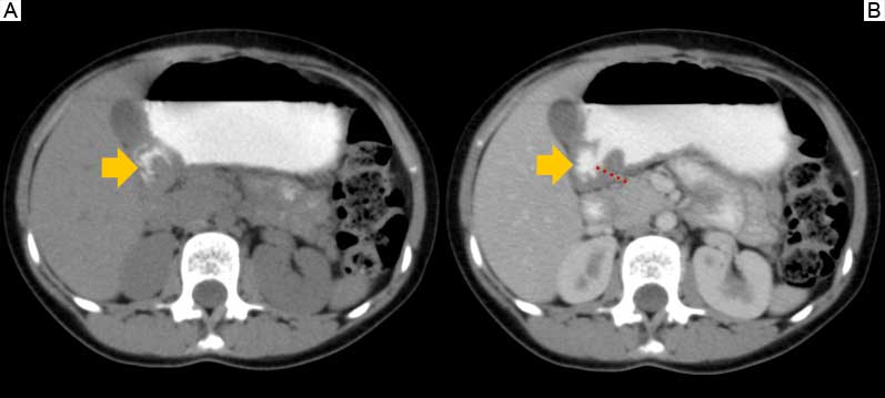 Pancreas Anular The Pancreas | Radiology Key