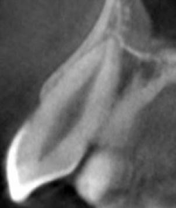 Assessment of Root Canal Anatomy of Maxillary and Mandibular Canine ...