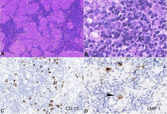 Sarcoid-like reaction: Hodgkin’s lymphoma is a hypothesis