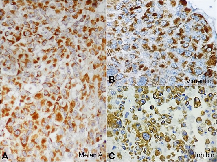 Giant virilising adrenal cortical carcinoma