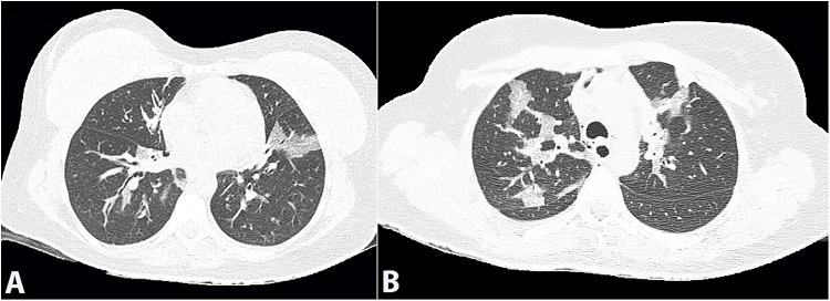 Reactive airways dysfunction syndrome following inhalation of hydrogen ...