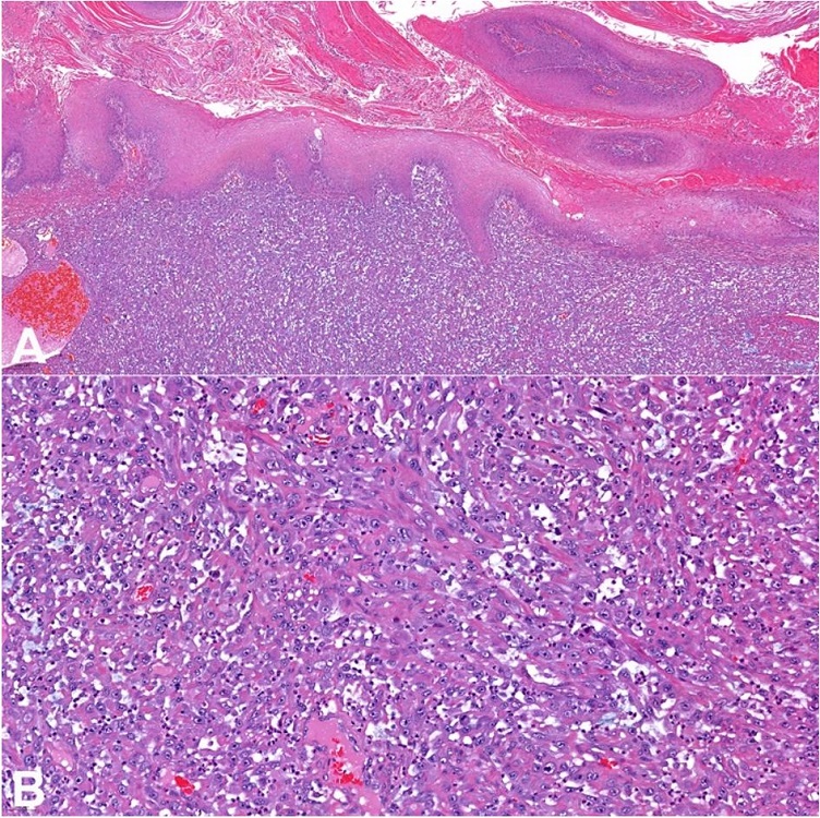 Squamous cell carcinoma with sarcomatous transformation of the penis