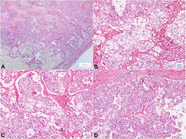 Sebaceous breast carcinoma