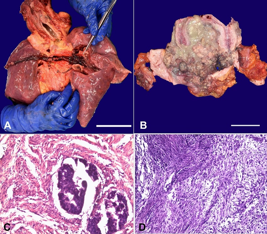 Fatal pulmonary thromboembolism associated with uterine carcinosarcoma