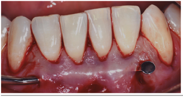 Use of dermal matrices to change gingival phenotypes