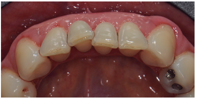 Use of dermal matrices to change gingival phenotypes