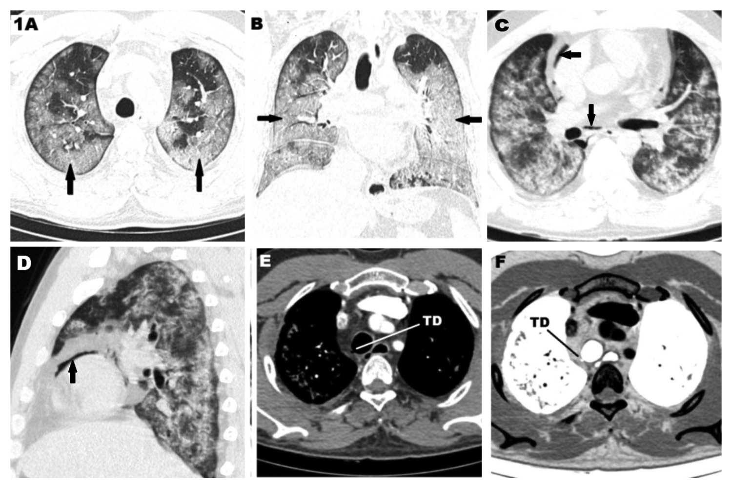 Tracheal Diverticulum in SARS-CoV-2 Patients on Non-Invasive Ventilation A not so “Spontaneous ...