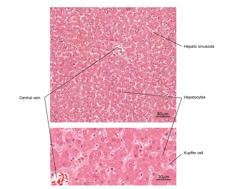 Histopathology of COVID-19: An illustration of the findings from fatal ...